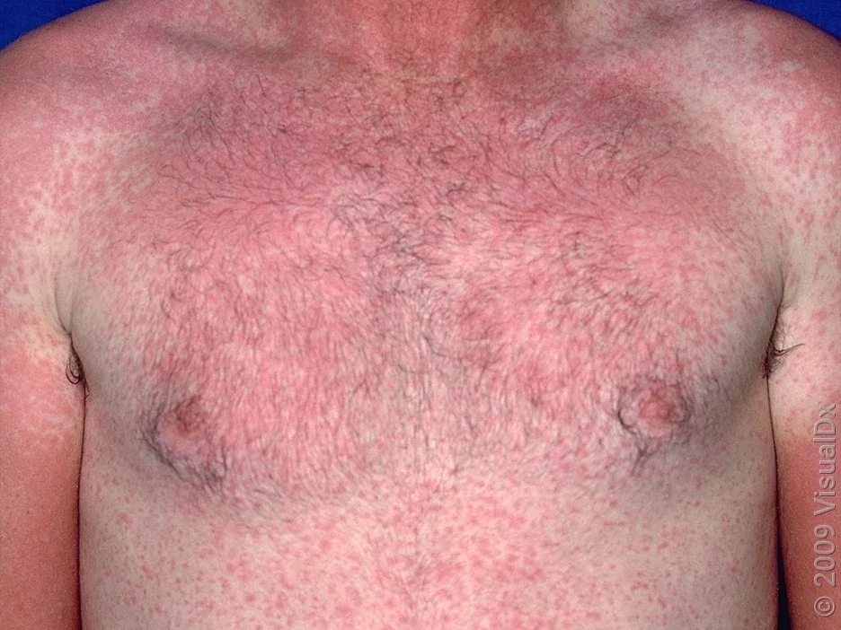 Drug Rashes: 7 Medications That Can Cause Skin Reactions - GoodRx