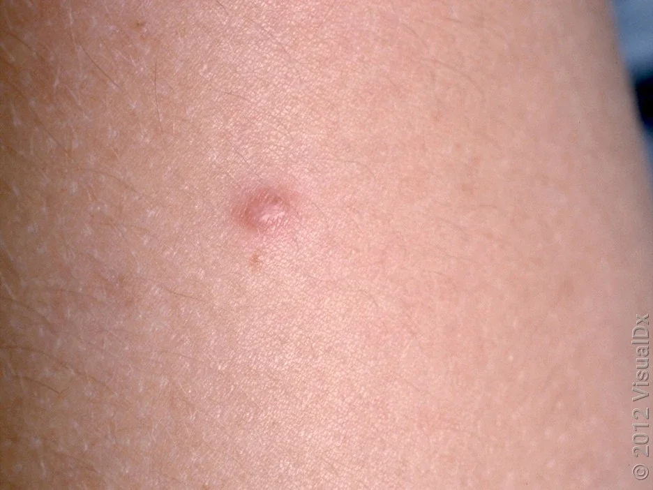 Dermatofibroma: Pictures, Causes, and Removal - GoodRx