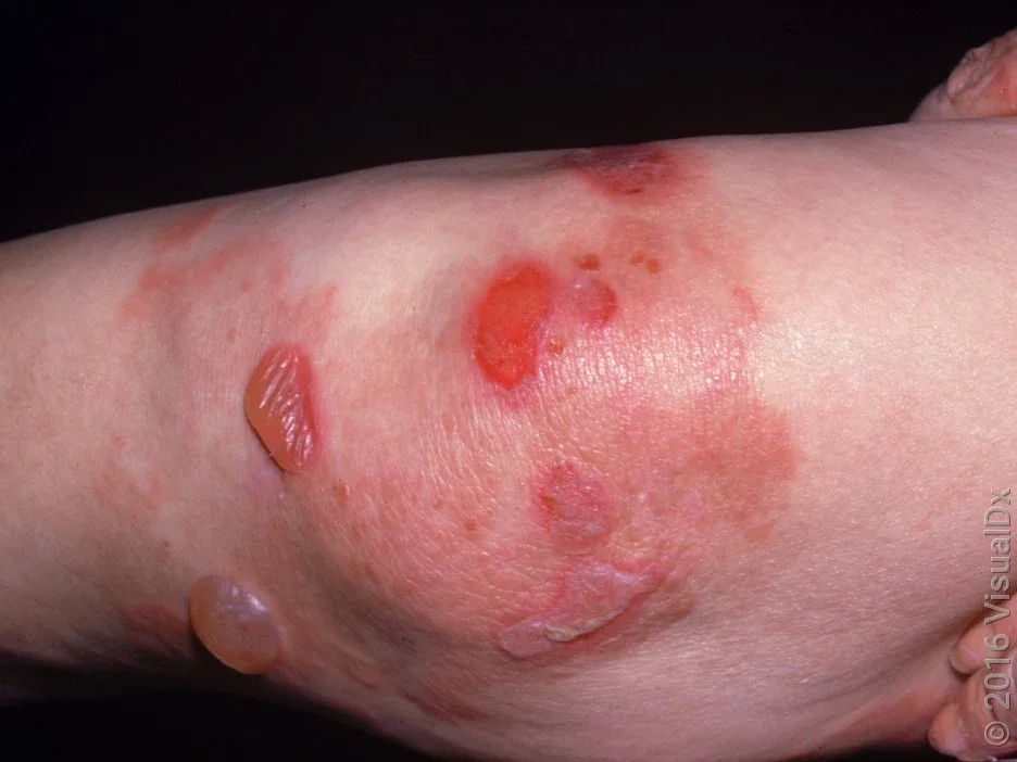 Bullous Pemphigoid Pictures: What Does It Look Like? - GoodRx