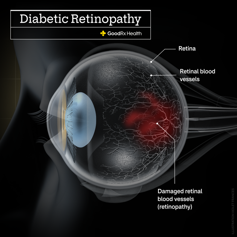 Diabetic Macular Edema (DME): Symptoms and Treatment - GoodRx