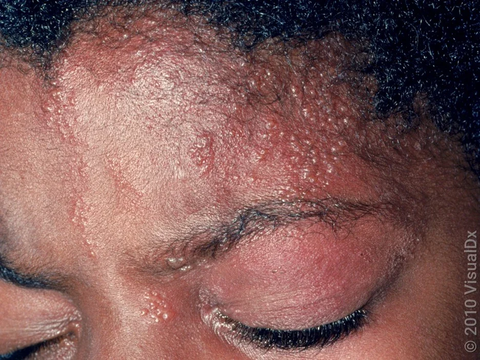 What Does a Shingles Rash Look Like? Stages in Pictures - GoodRx