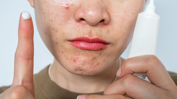 Retinol vs. Retin-A for Acne Treatment: Which is Better? - GoodRx