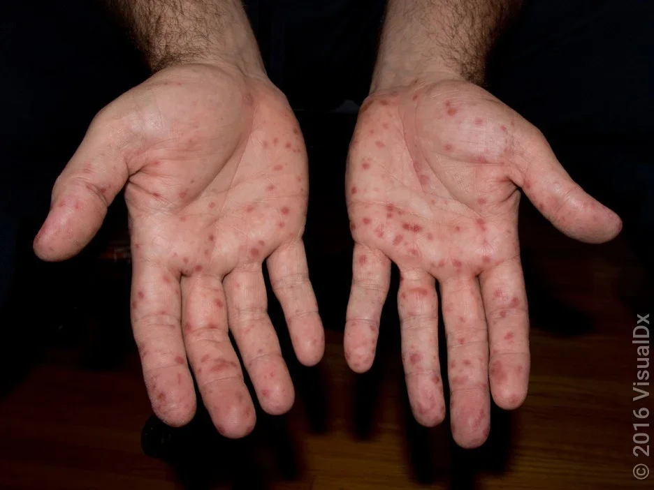 Hand, Foot, and Mouth Disease (HFMD): Pictures, Symptoms, Causes - GoodRx