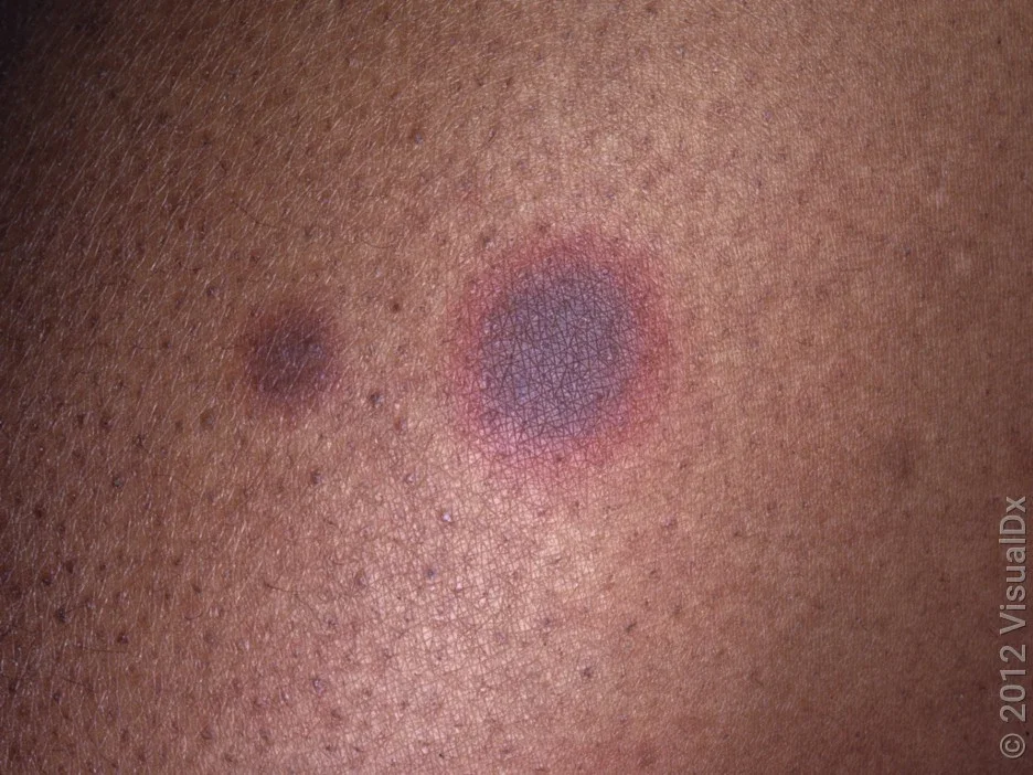 Drug Rashes: 7 Medications That Can Cause Skin Reactions - GoodRx