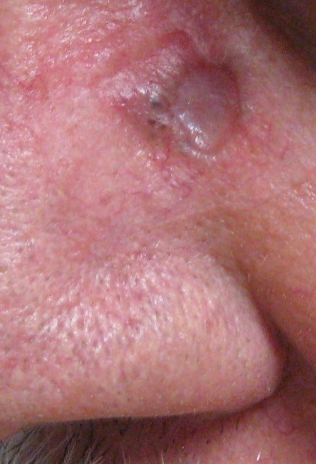 What Does Skin Cancer Look Like? - GoodRx