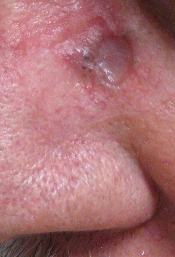 What Does Skin Cancer Look Like? - GoodRx