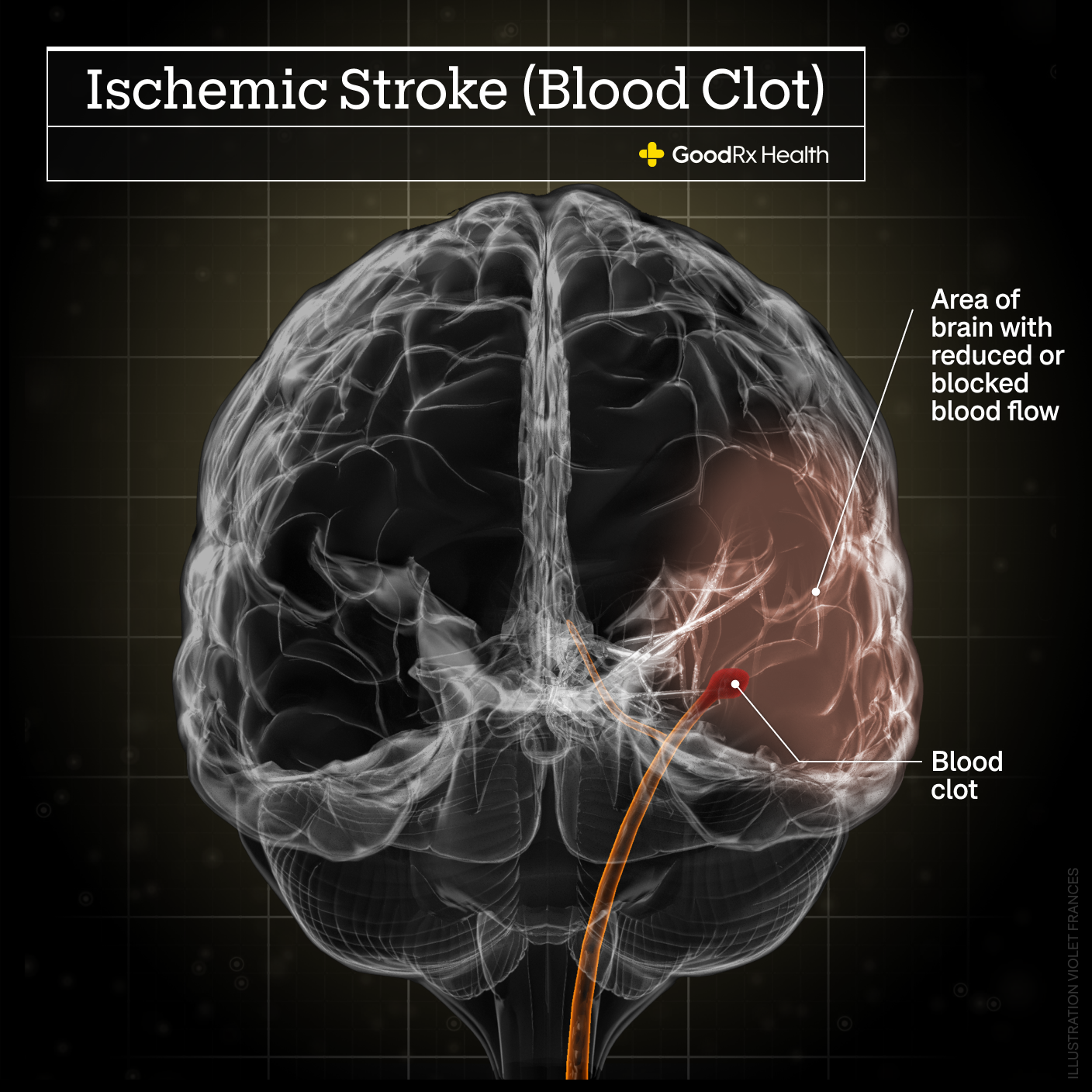 Comparison of Antiplatelet Medication Types and Effectiveness - GoodRx