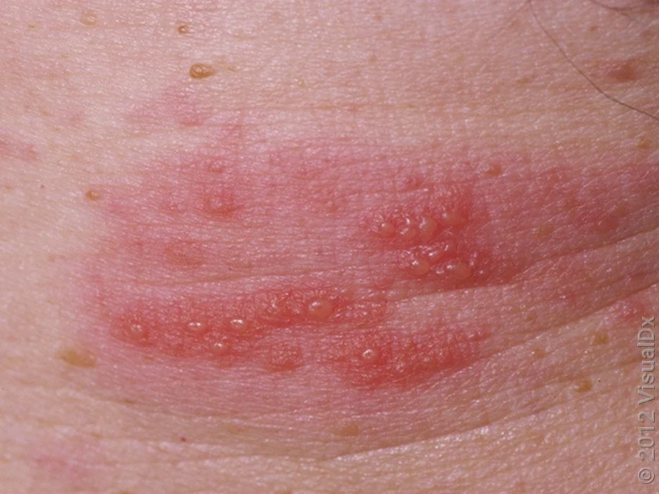 Is It Possible to Get Shingles If You Never Had Chickenpox? - GoodRx