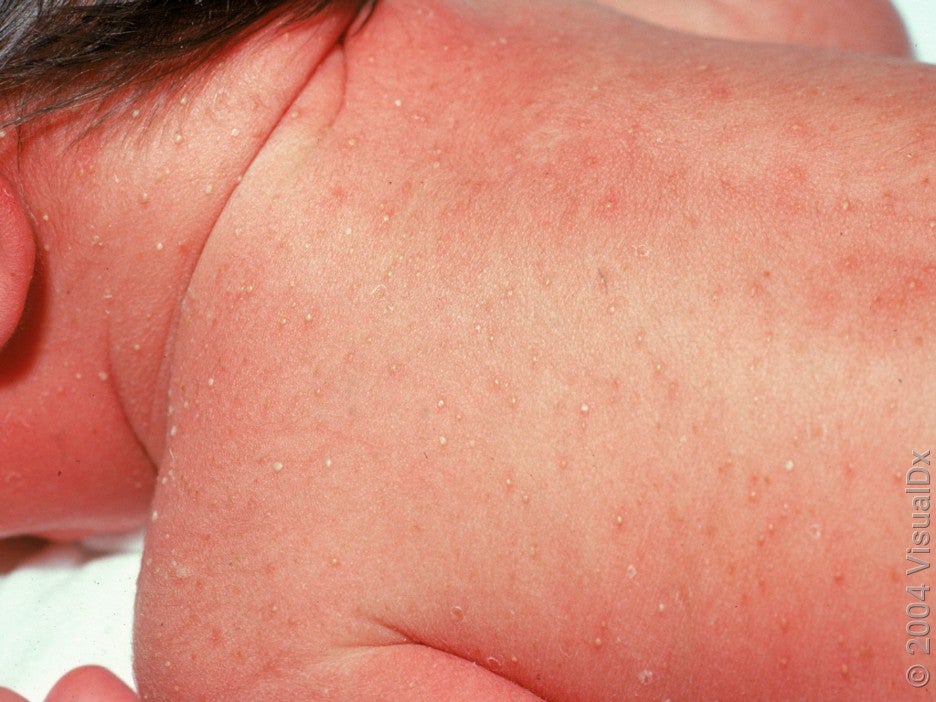How to Know If Your Baby Has Acne, Plus Signs to Look For - GoodRx