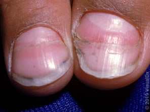 8 Ways Psoriatic Arthritis Affects the Nails - GoodRx