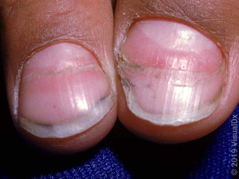 8 Ways Psoriatic Arthritis Affects the Nails - GoodRx