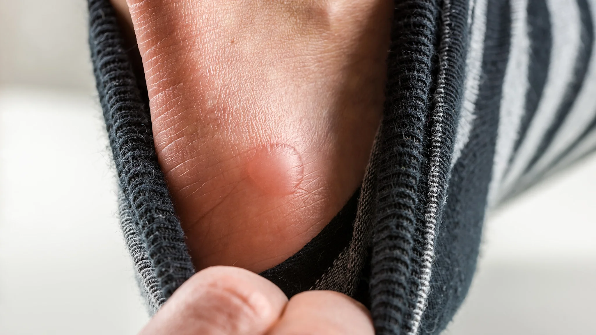Should You Pop a Blister? How to Safely Treat Blisters at Home - GoodRx