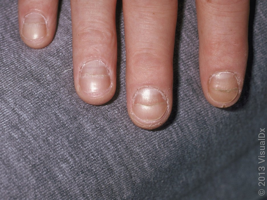 5 Signs of Vitamin Deficiency in Nails - GoodRx