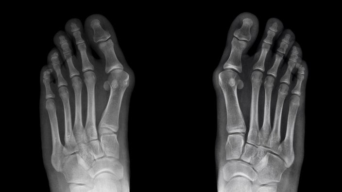 How Much Does Bunion Correction Surgery Cost? - GoodRx