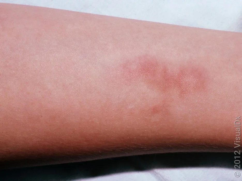 Erythema Nodosum: Symptoms, Causes, and Pictures - GoodRx