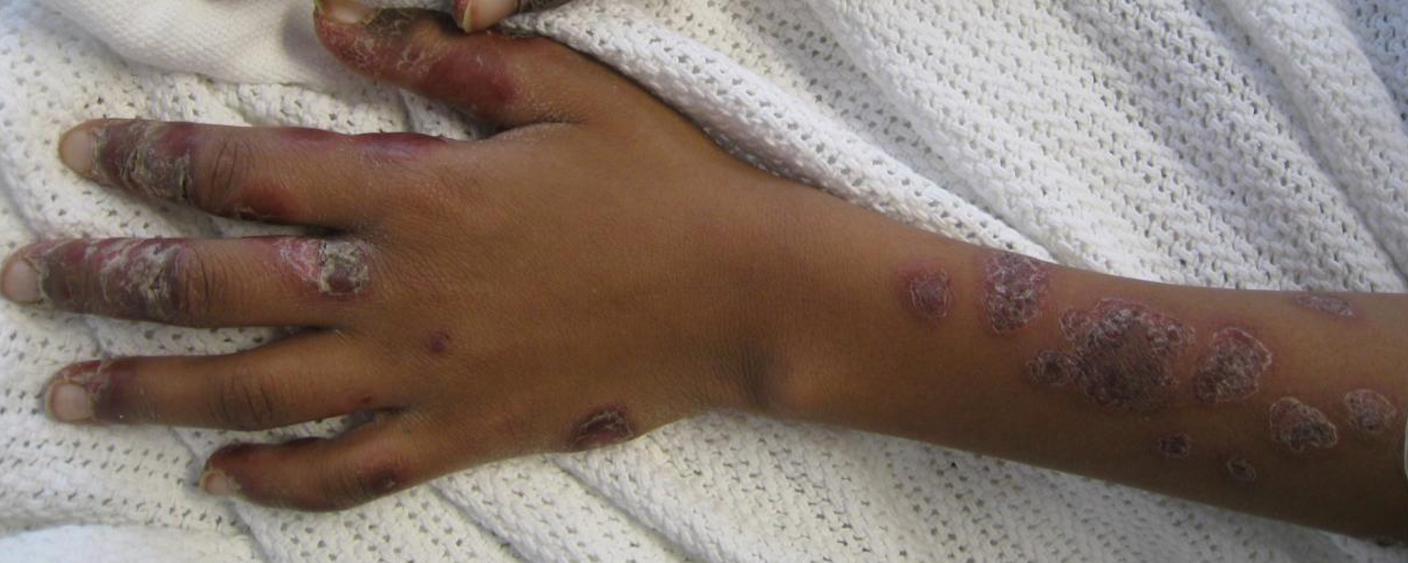 Lupus Rash: What It Is and How to Treat It - GoodRx