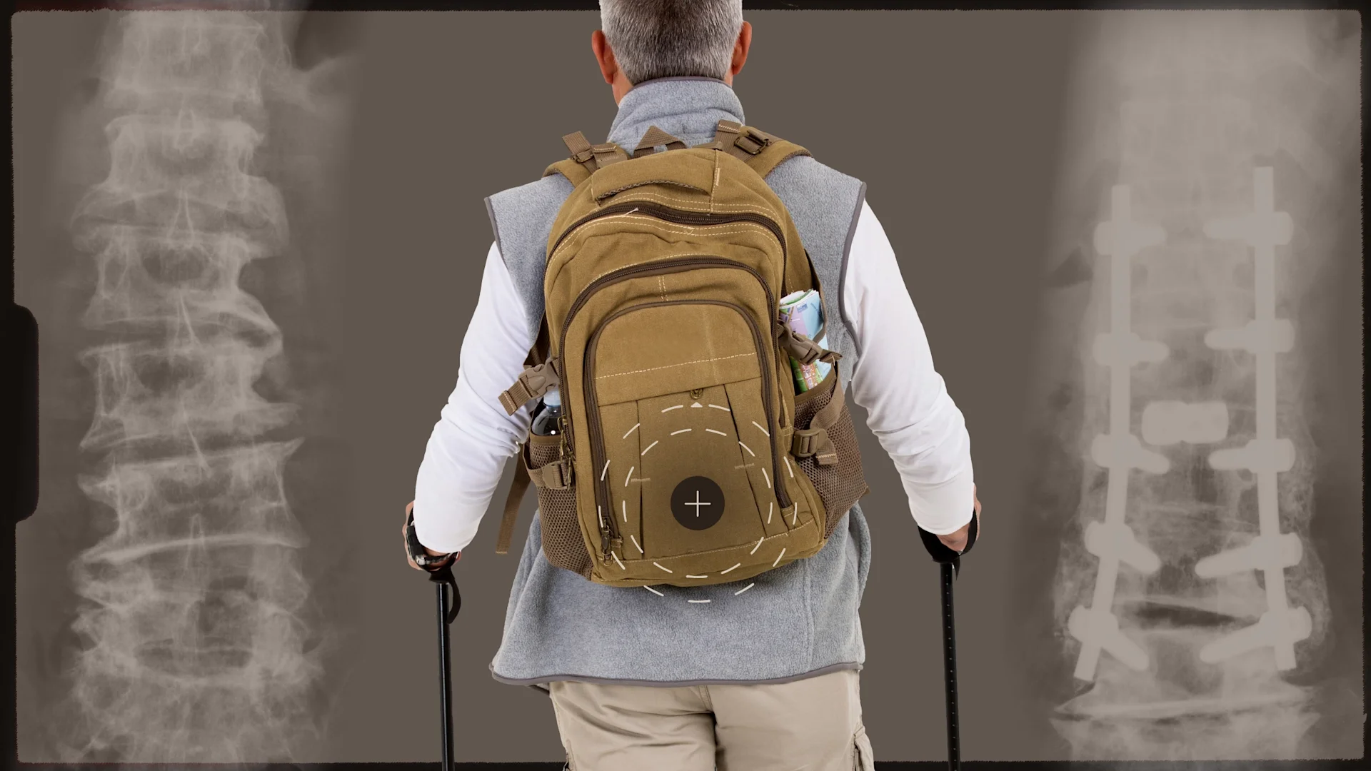 Spinal Fusion Surgery Recovery: Here’s What to Expect - GoodRx