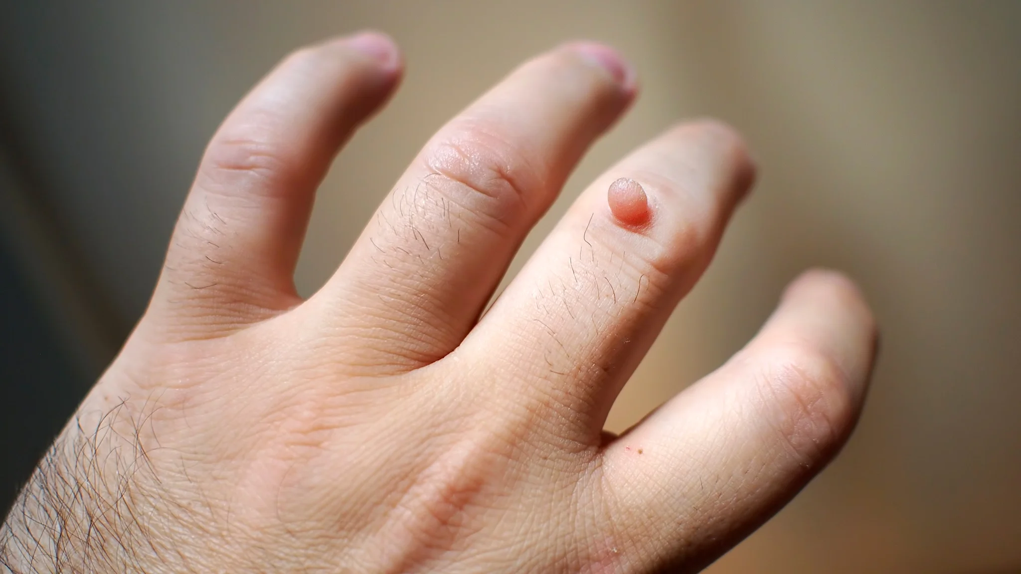 6 Pictures of Warts and How to Treat Different Types - GoodRx