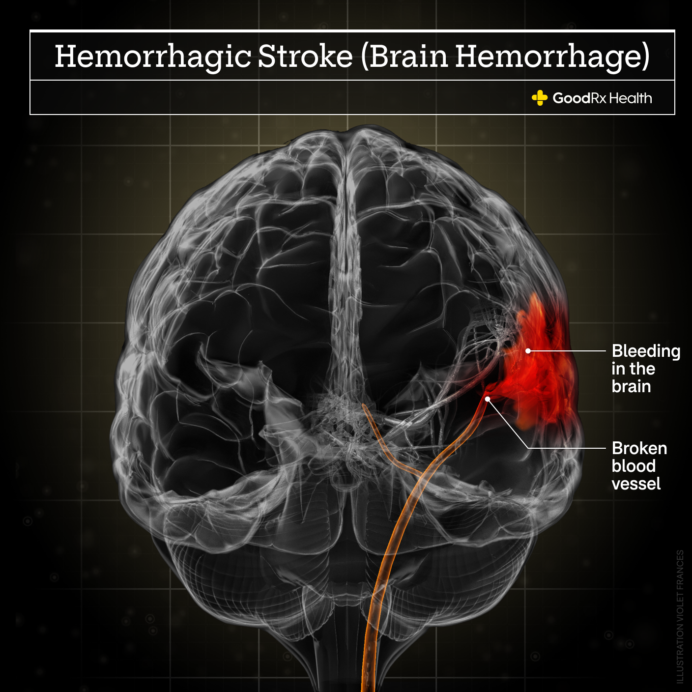 The Differences Between Bell's Palsy vs. Stroke - GoodRx
