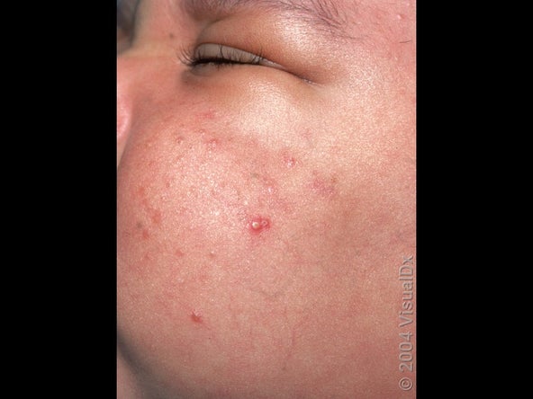 How to Know If Your Baby Has Acne, Plus Signs to Look For - GoodRx