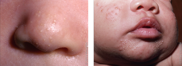 How to Know If Your Baby Has Acne, Plus Signs to Look For - GoodRx