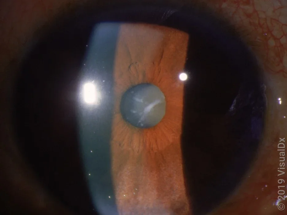 Cataracts: Causes and Prevention (With Images) - GoodRx