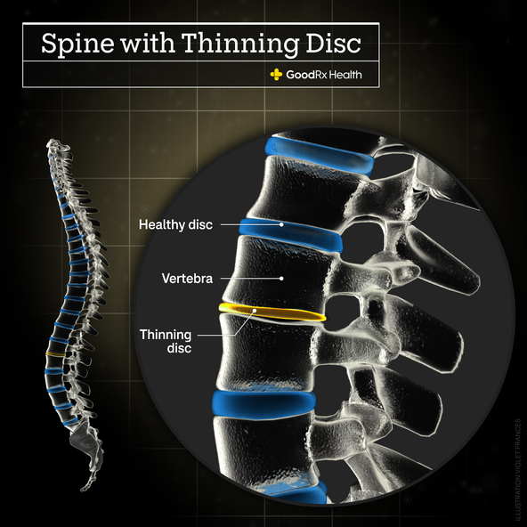 How to Treat Degenerative Disc Disease - GoodRx