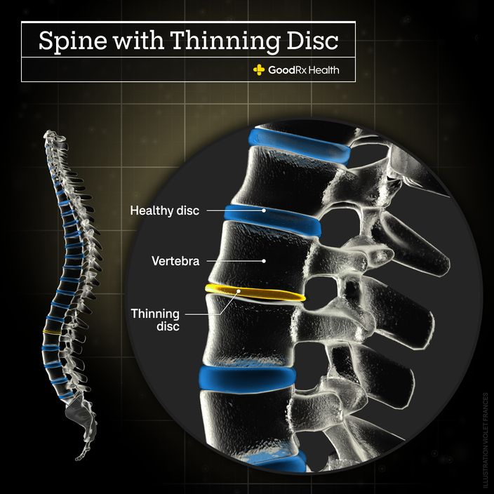 How to Treat Degenerative Disc Disease - GoodRx