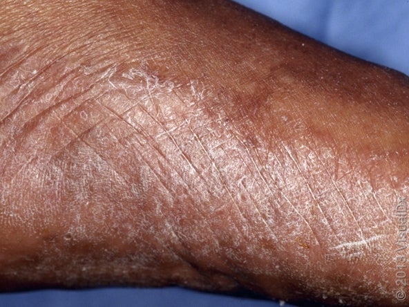 Athlete’s Foot (Tinea Pedis): Causes, Images, and Treatment - GoodRx