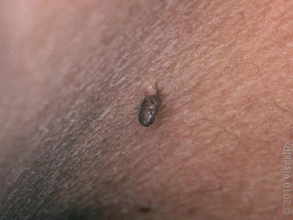 Diabetes Rash: Photos, Causes, and Care - GoodRx