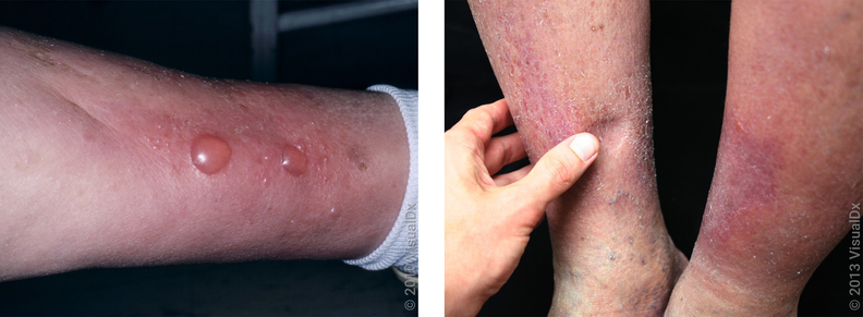 Venous Stasis Dermatitis: Images, Causes, and Treatment - GoodRx