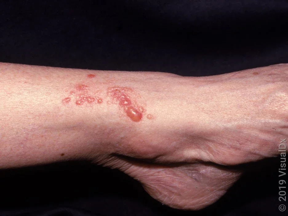 How Long Does a Poison Ivy Rash Take to Heal? - GoodRx