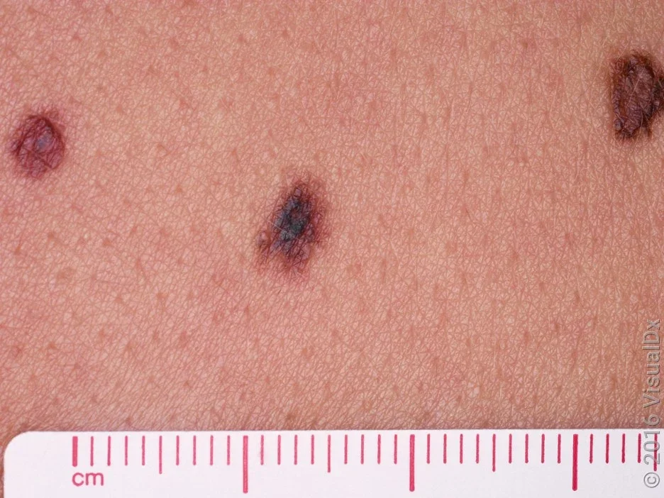Atypical Moles: Causes, Symptoms, and Treatment (With Images) - GoodRx