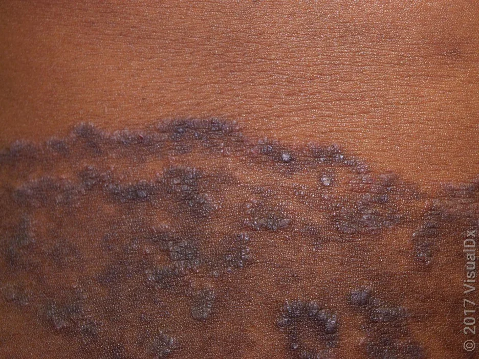 Jock Itch: Cause, Treatments, and Symptoms (With Pictures) - GoodRx