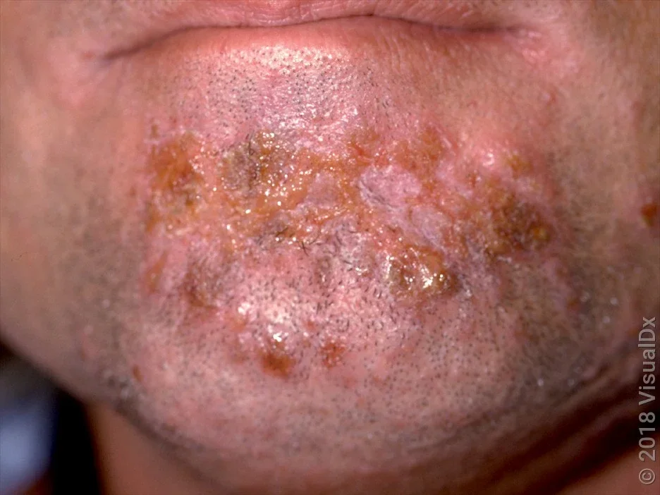 What Is Impetigo? Causes, Symptoms, Treatment - GoodRx