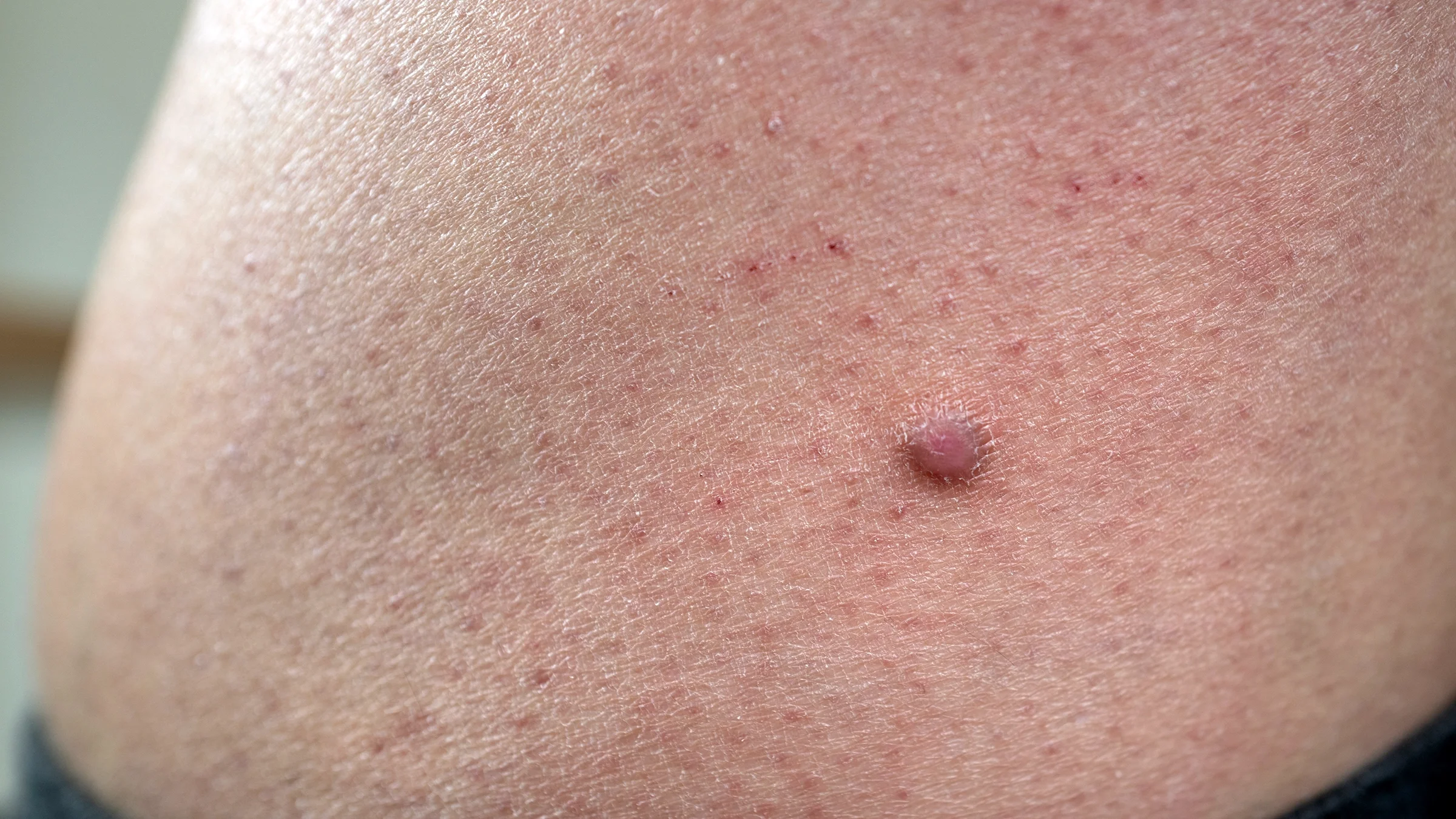 Dermatofibroma: Pictures, Causes, and Removal - GoodRx