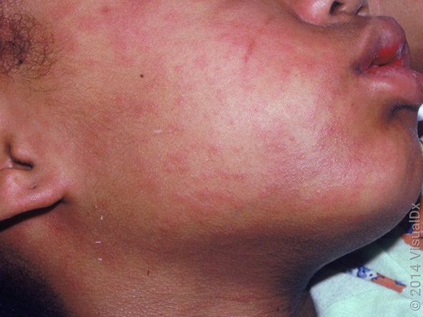 Rubella vs. Rubeola (Measles): Differences, Photos, and More - GoodRx