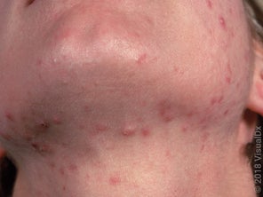 Acne Treatment: A Complete Guide (With Images) - GoodRx