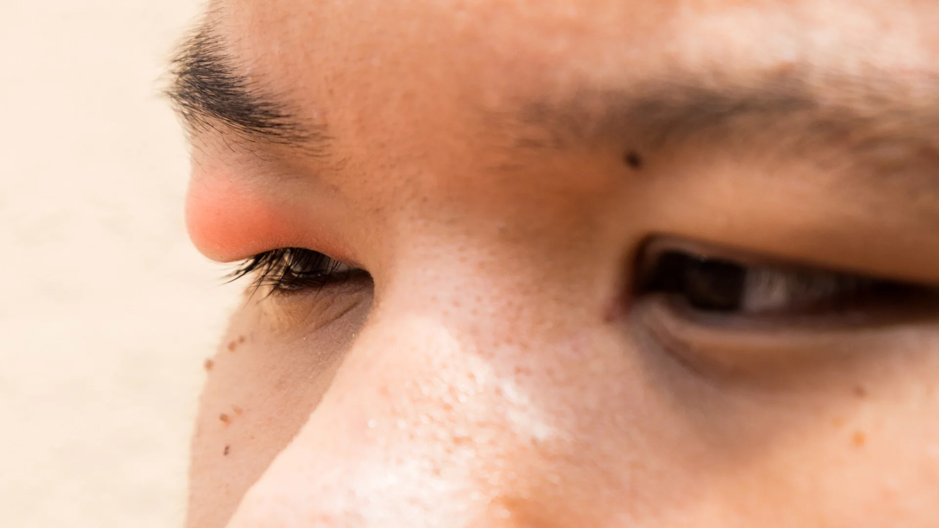 How Can You Get Rid of a Stye Fast? - GoodRx