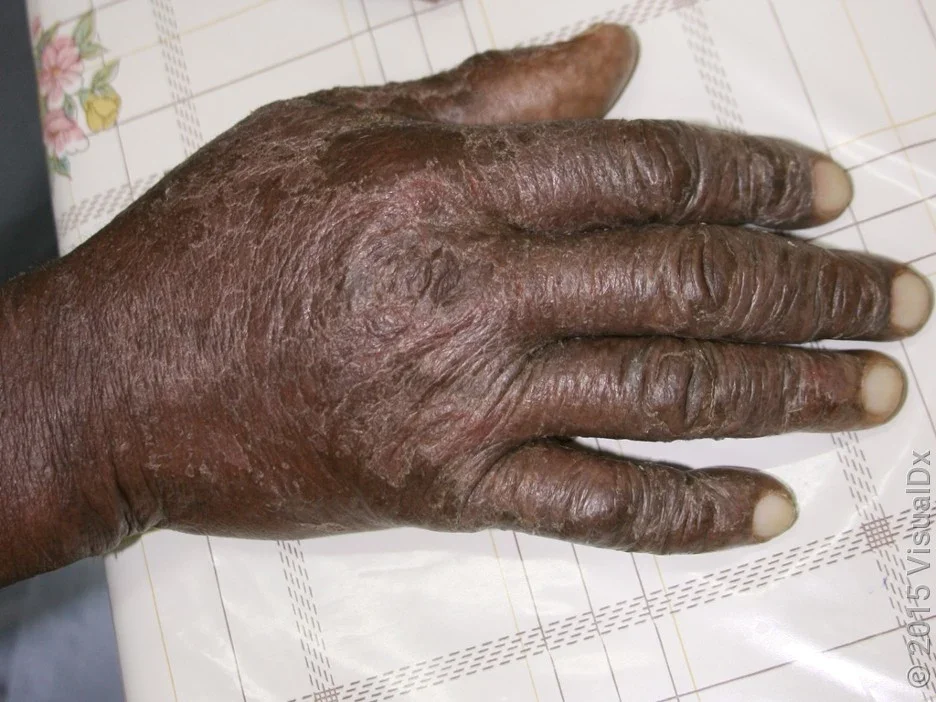 Treating Eczema on Hands and Fingers (With Pictures) - GoodRx