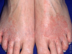 Ringworm: Symptoms, Pictures, Causes, Treatment, & More - GoodRx