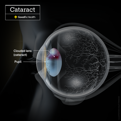 What Do Cataracts Look Like? Pictures and Symptoms - GoodRx