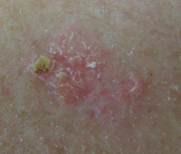 What Does Skin Cancer Look Like? - GoodRx