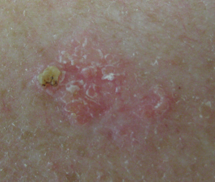 What Does Skin Cancer Look Like? - GoodRx