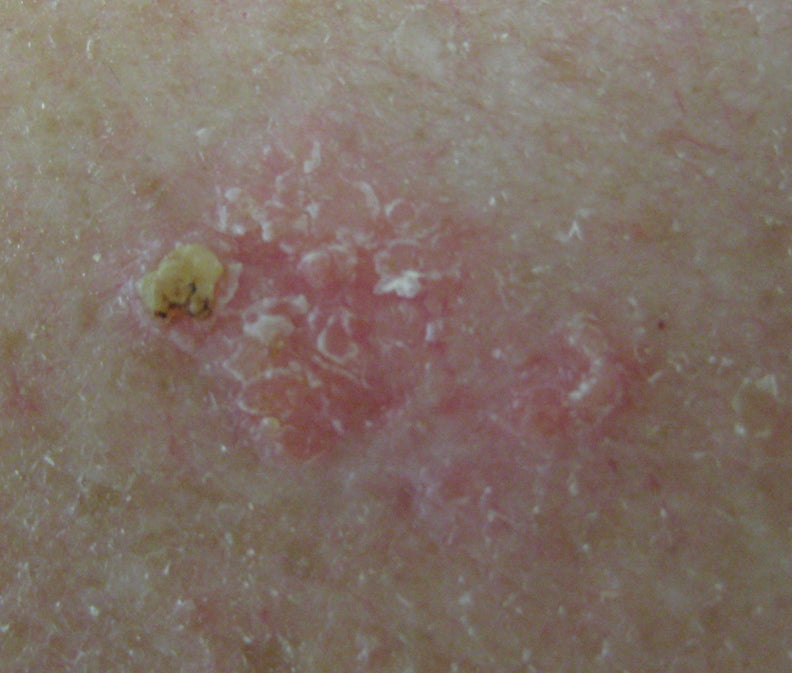 What Does Skin Cancer Look Like? - GoodRx