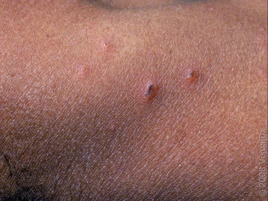 difference between bed bugs and chicken pox