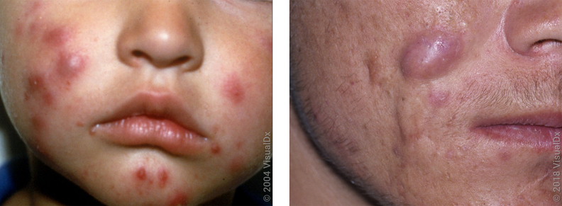 Different Types of Acne and Treatment (With Pictures) - GoodRx