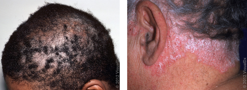 What Is Scalp Eczema? Treatment, Causes, Triggers, & Images - GoodRx