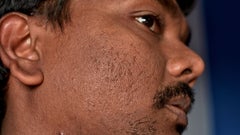 Differin gel (Adapalene): Uses, Alternatives, FAQs & More - GoodRx