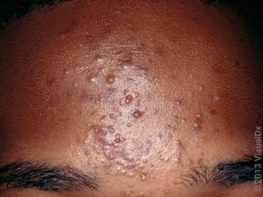 Acne Treatment: A Complete Guide (With Images) - GoodRx